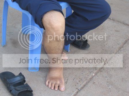 Elephantitis RiTricks: Elephantiasis